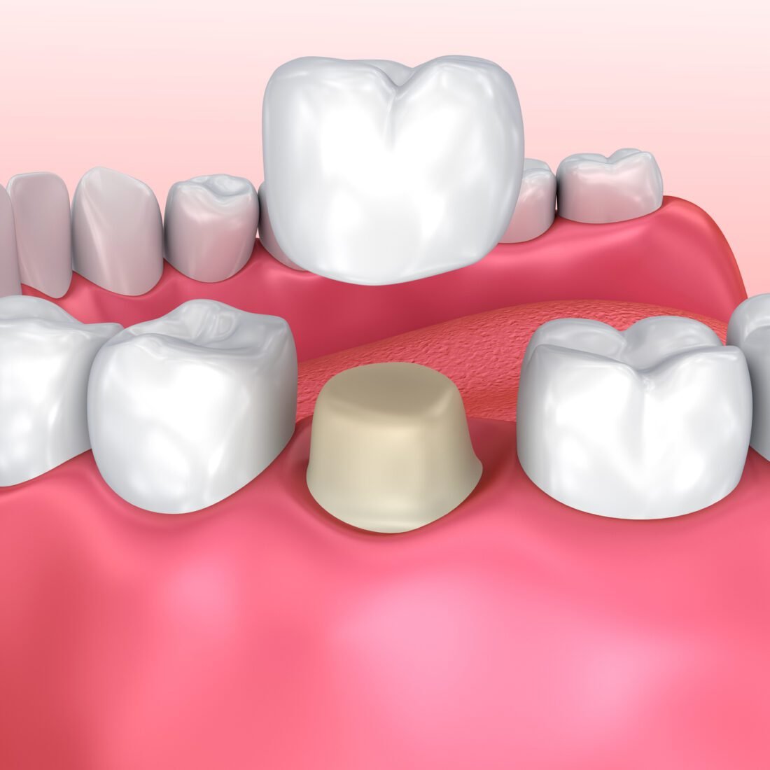 Caring for Your Temporary Crown: What You Need to Know - Smile n Shine ...