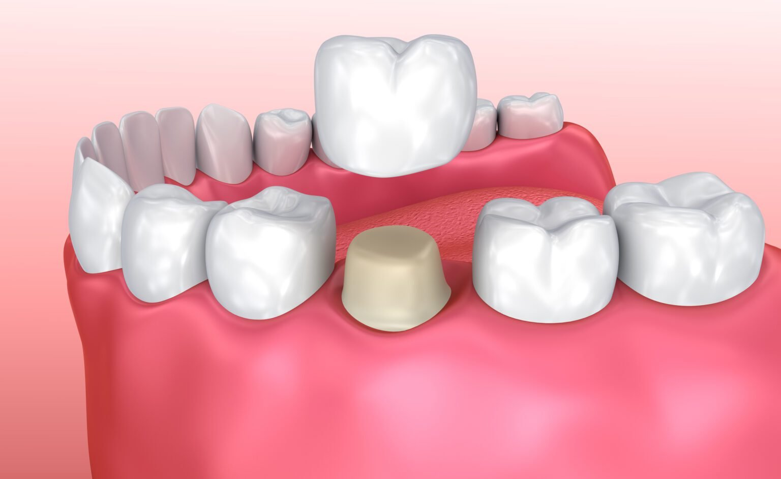 Caring for Your Temporary Crown: What You Need to Know - Smile n Shine ...