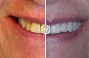 The UK Smile Makeover Boom: What Patients Need to Know Before Taking ...